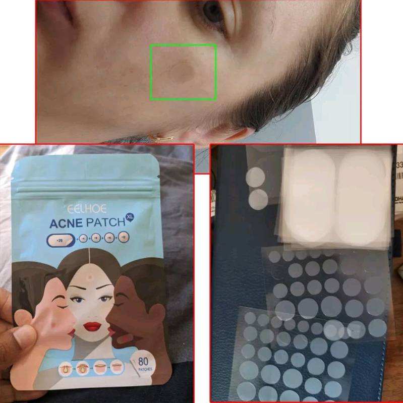 Parche para imperfecciones fáciles granos en Ciudad de Mexico