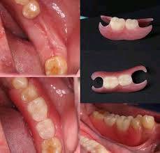 Valplast Unilateral en San Salvador