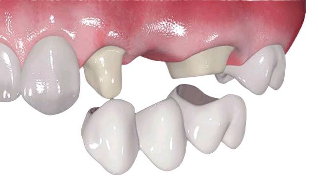 Prótesis fija en Lima