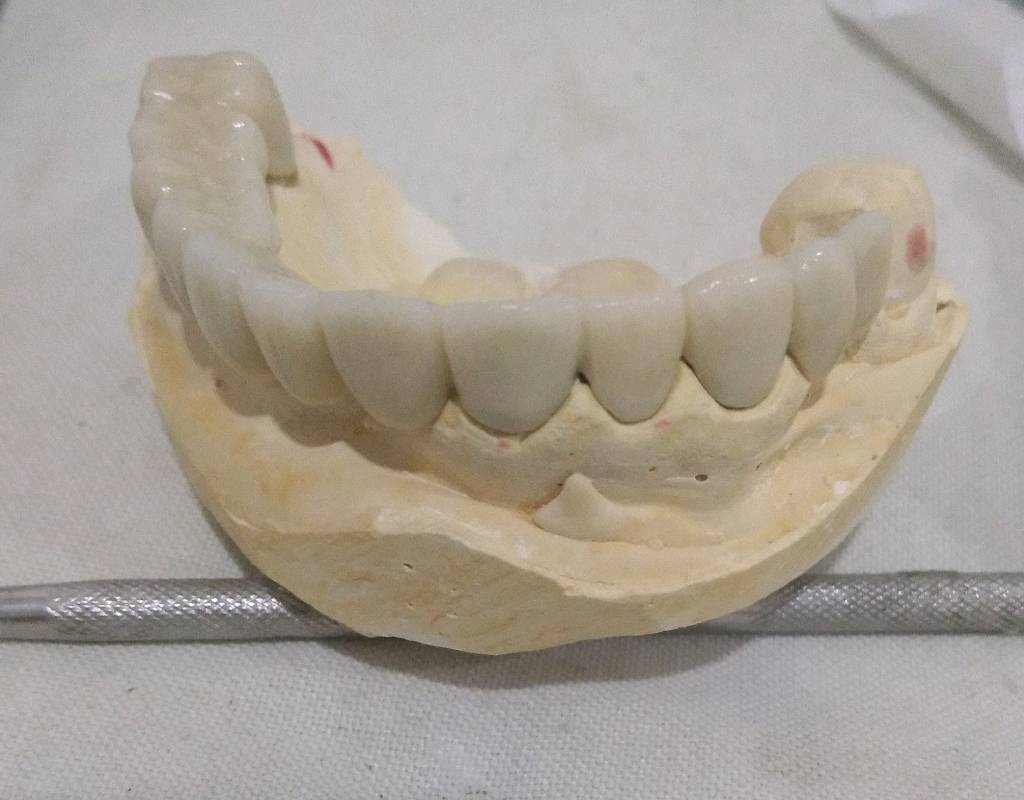 Prótesis fija en porcelana en Santa Marta