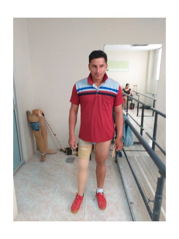 Protesis Transfemoral Sobre Rodilla En Guayaquil