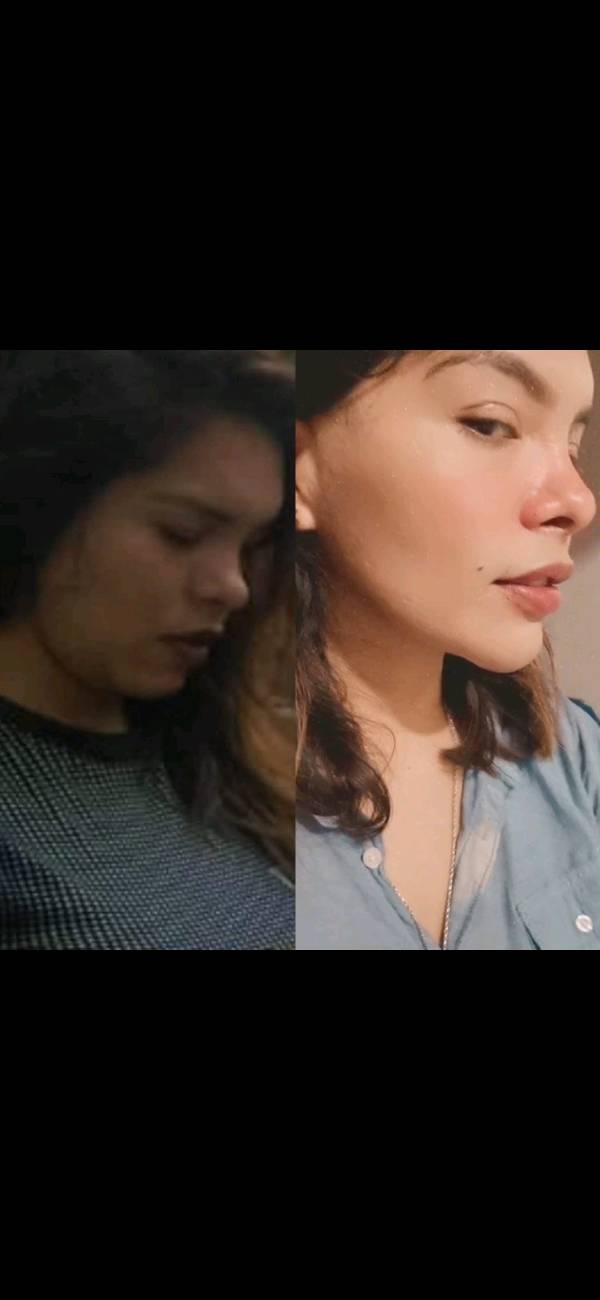 Lipoperfilamiento de Cachete, papada y angulo mandibular en colonia Roma