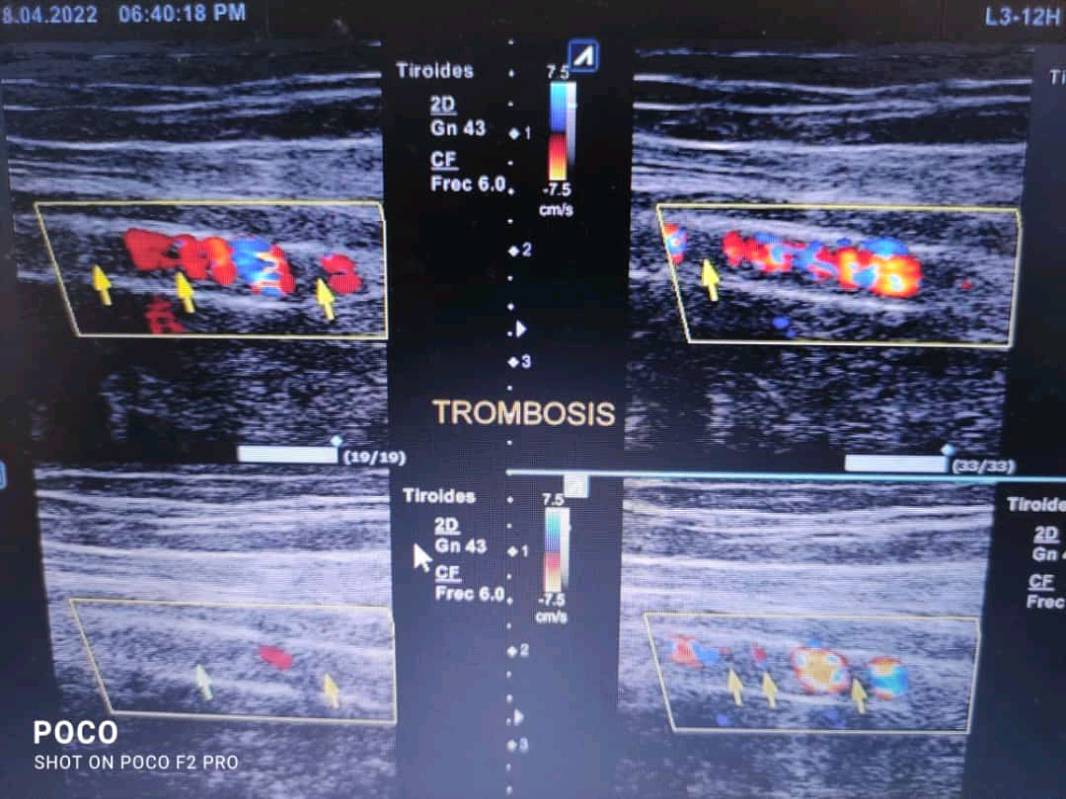 Ecografía doppler vascular de miembros inferiores en Santa Rosa