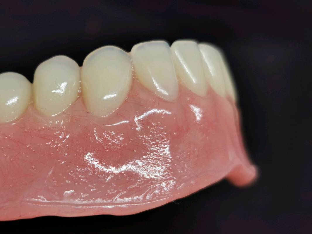 Protesis total acrílica en Tababela